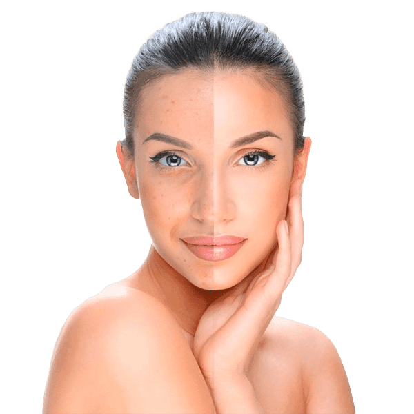 Botox Specials & Deals in NYC & Long Island - Trifecta Med Spa