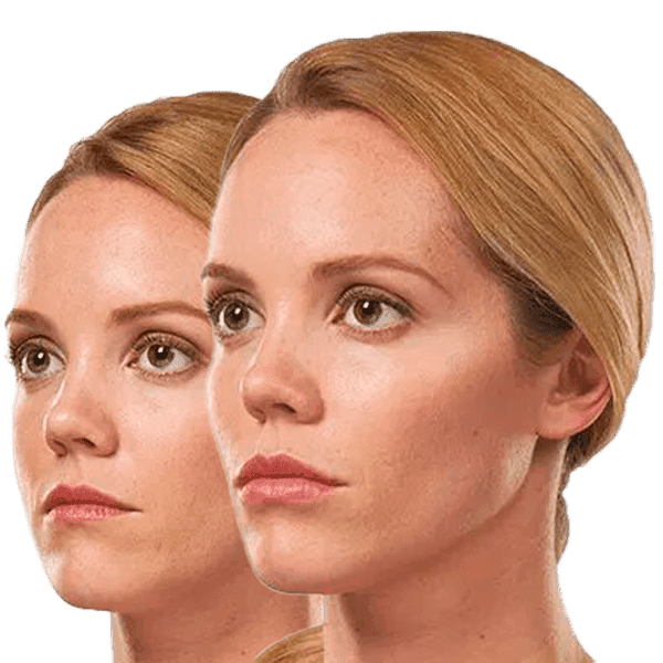 Before After Photos - Trifecta Med Spa