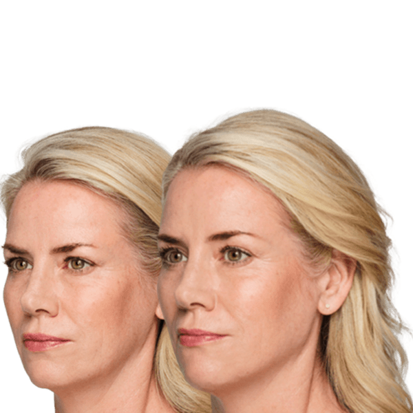 Juvederm VOLUX XC / Juvederm Jawline