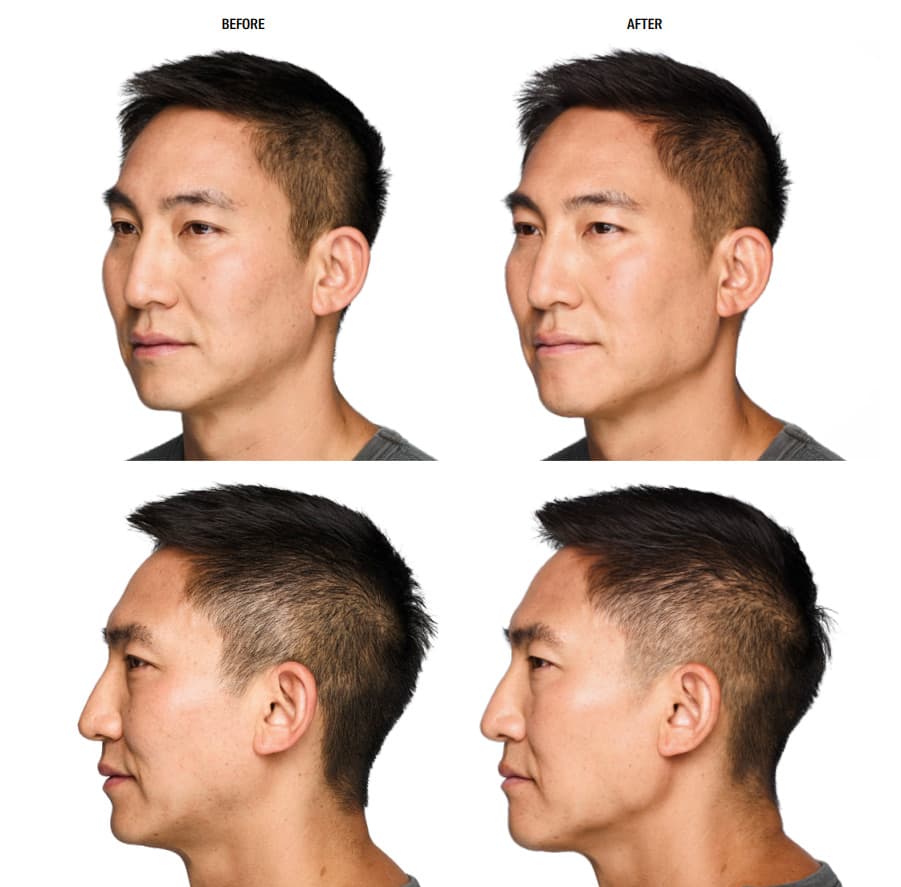 Juvederm VOLUX XC / Juvederm Jawline